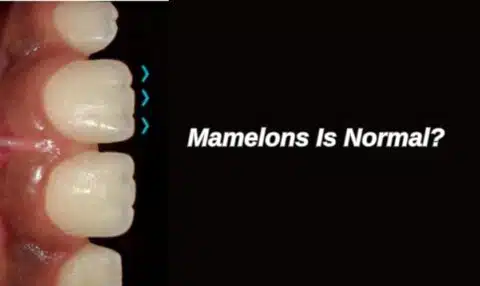 Mamelon Teeth in Adults: Normal or Not?