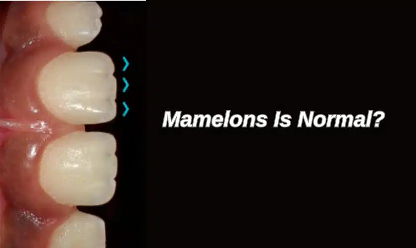 Mamelon Teeth in Adults: Normal or Not?