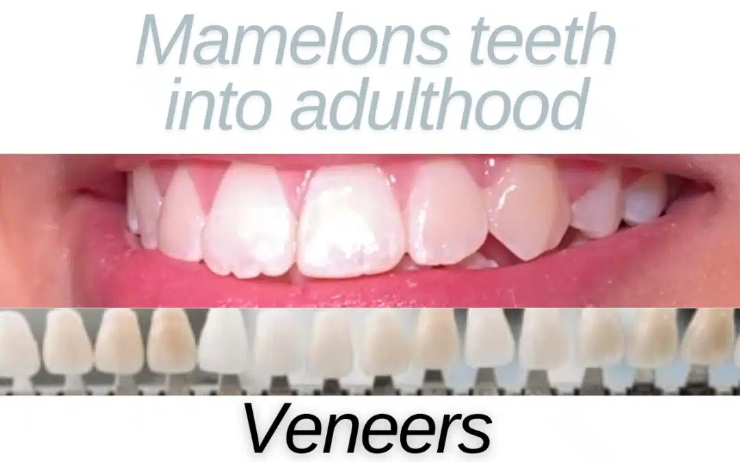 Are Mamelons Genetic? Veneers Might Be the Right Choice