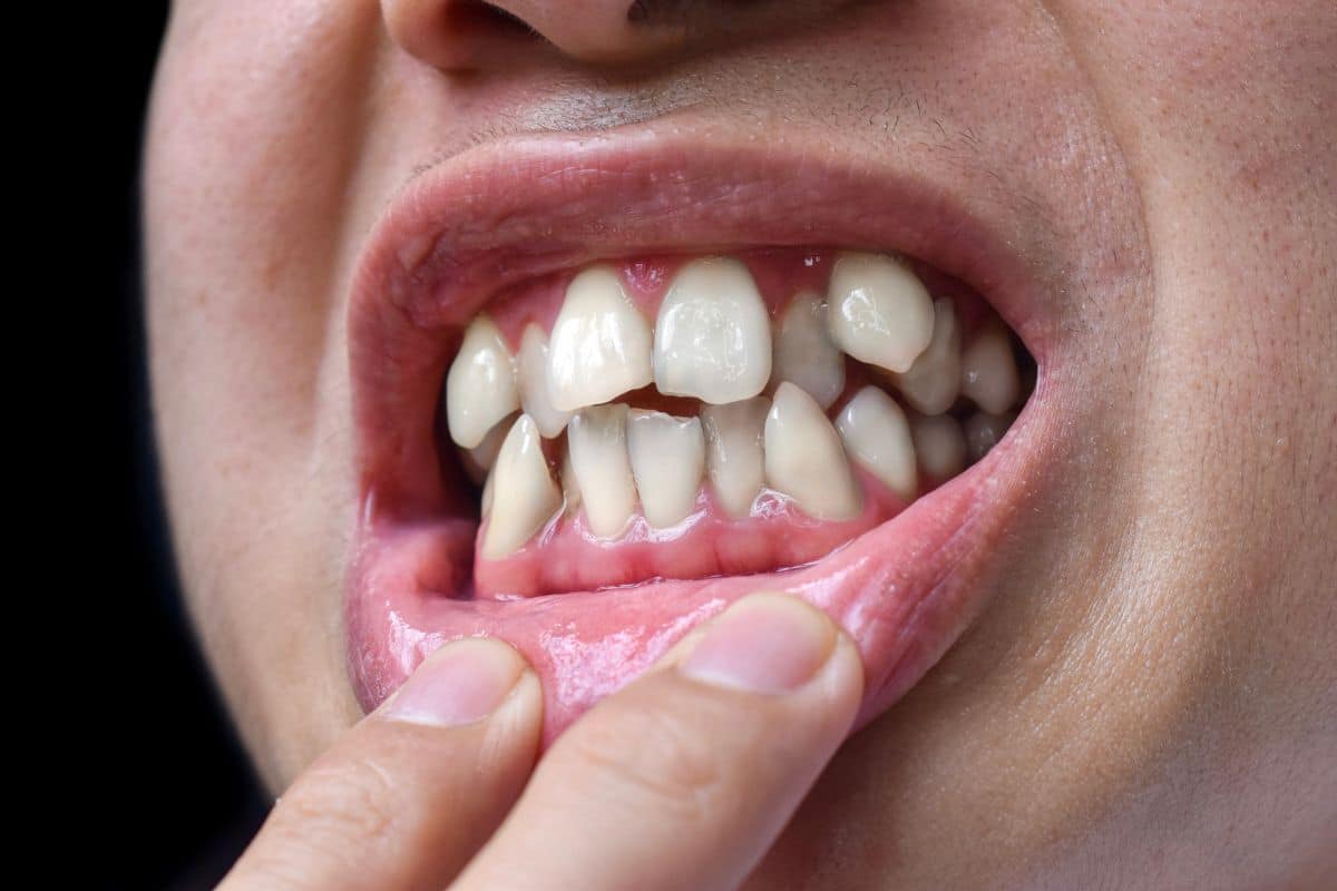 How to Fix Crooked Teeth Without Braces