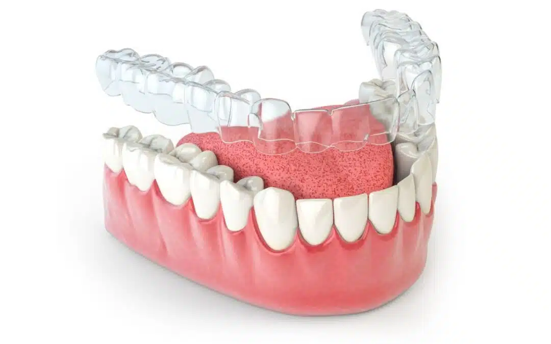 Invisalign With Gum Disease – What You Need to Know