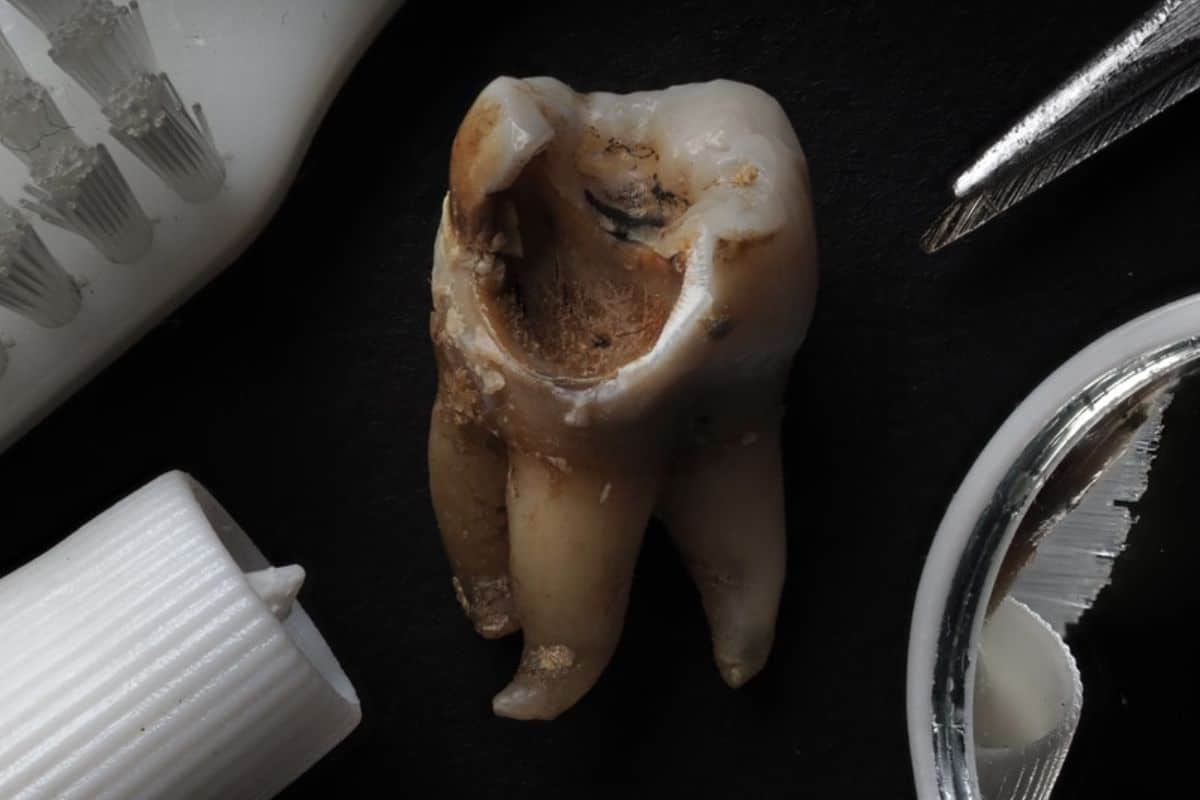What Should You Do About a Wisdom Tooth Cavity?